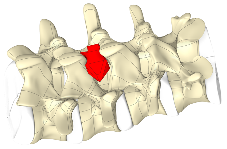Smart-Dynamic Spine Implant